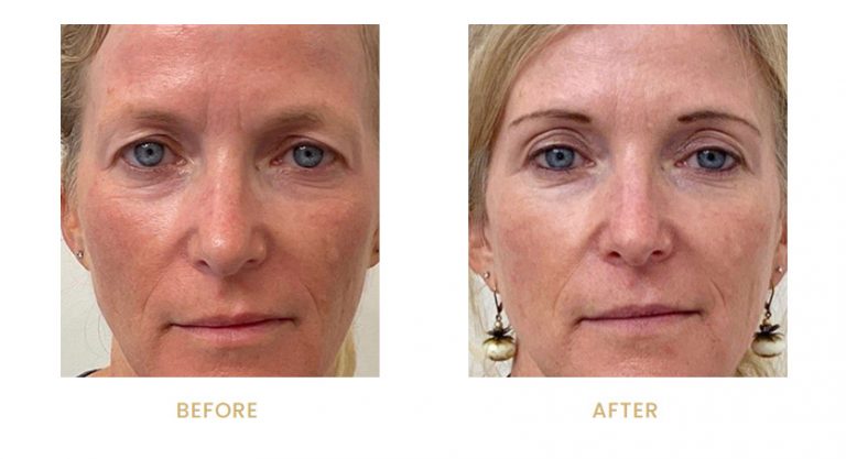 AgeJET Plasma Skin Treatments Manchester | Emzi Skin Clinic